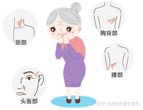 中国镇痛周之会呼吸的痛带状疱疹 知乎