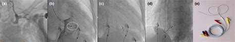 A Angiography Showed An Occluded Left Subclavian Vein B Download Scientific Diagram