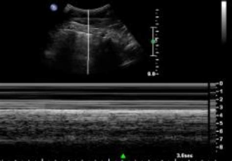 Pocus Made Easy Efast • Litfl • Ultrasound Library