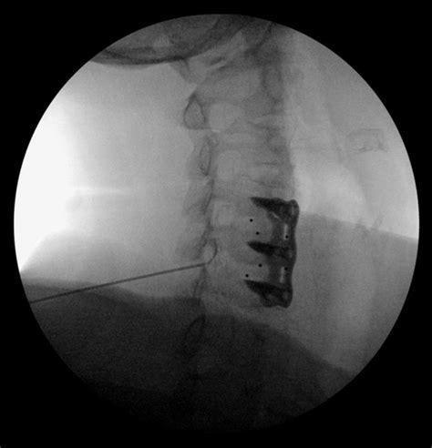 Cervical Epidural Steroid Injection Dr Marios Moniatis