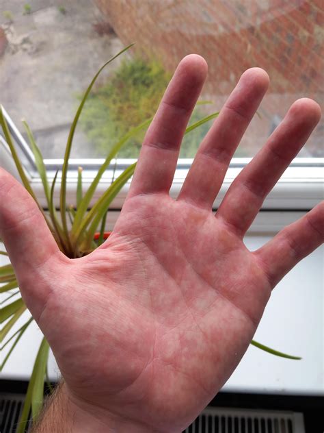 What Is This A Rash A Bug Bite An Allergic Reaction I Got The All