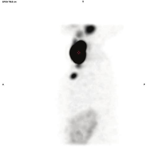 Single Photon Emission Computed Tomography Image Shows That The Uptake Download Scientific