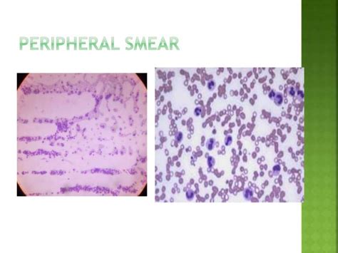 Leukemoid Reaction And Leukemia Pptx