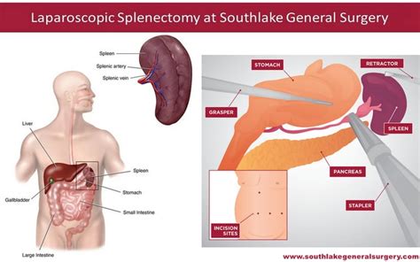 Why Laparoscopic Splenectomy Is Required R Laparoscopy