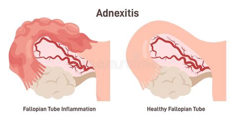 Salpingitis Or Adnexitis Infection And Inflammation In The Fallopian Tube Stock Vector