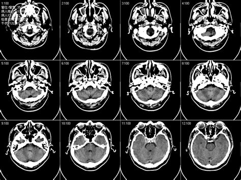 The Batch Reading Brain CT Data Display Format 34 Download Scientific Diagram