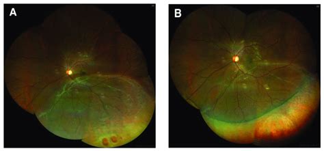 A 32 Year Old Woman Showed Rhegmatogenous Retinal Detachment With A Pe Download Scientific