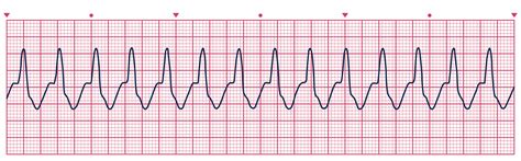 Unc Media Heart Rhythms