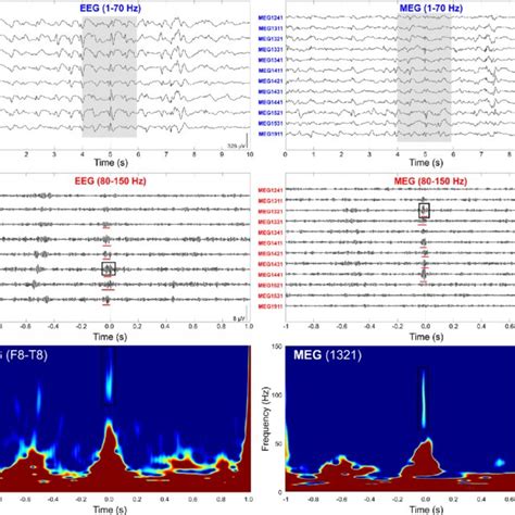 High Frequency Oscillations Hfos Vs Artifactual Oscillations Download Scientific Diagram