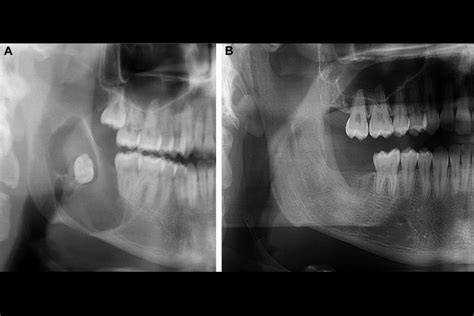 Odontogenic Keratocyst