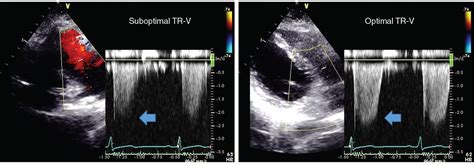 Detection And Characterization Of Diastolic Dysfunction Clinical Tree