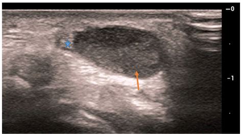 A Wrist Median Nerve Schwannoma A Case Report Insight Medical Publishing