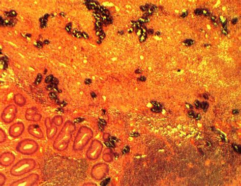 Microphotograph Of The Appendix Showing Numerous Schistosomal Calcified Download Scientific