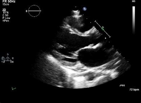 Echo Of Patient On The Post Operative Day 1 Dilated Lv Severely