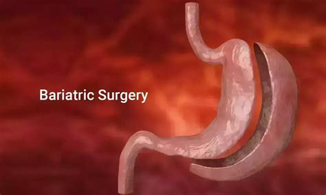 Bariatric Surgery Associated With Disease Remission In Women With Pcos