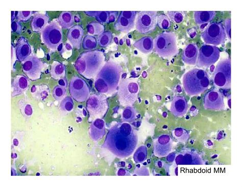 Fna Cytology Of Metastatic Malignancies Ppt