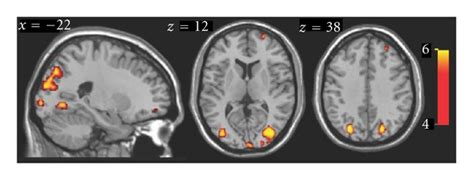 Cortical Maps Showing Brain Areas Where Activity Was Significantly