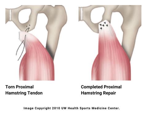Proximal Hamstring Rupture Dr Edward S Chang MD