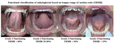 Myofunctional Therapy Crash Course
