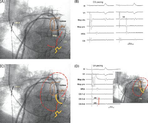 Conduction Block Of The La Isthmus Prior To The Ablation Conduction Download Scientific