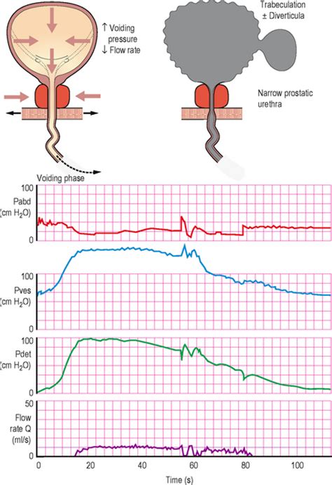 Voiding Disorders And Bladder Outlet Obstruction Abdominal Key