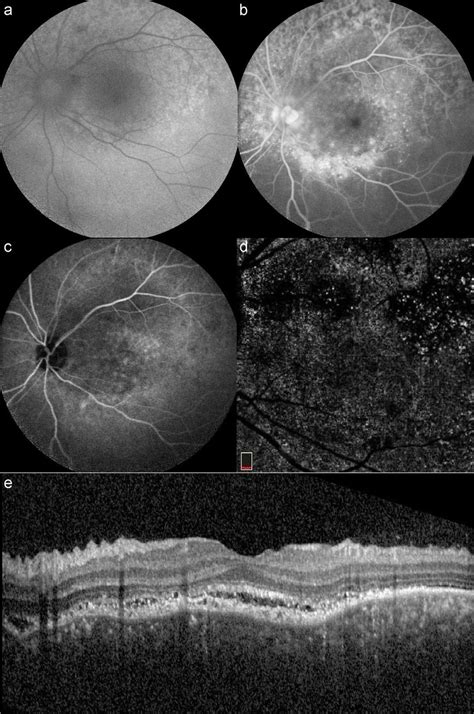 A Fundus Autofluorescence Shows Mild Hypo And Hyperautofluorescence At Download Scientific