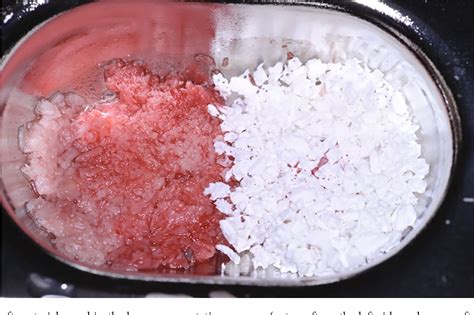 Figure 1 From Barbell Technique For Three Dimensional Bone Augmentation