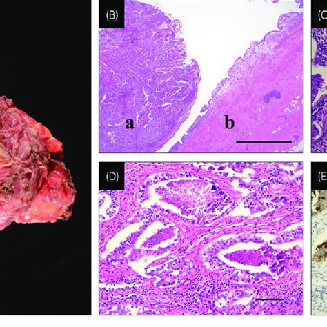 A Gross Pathology A Single Mass Comprising The Bladder Prostate