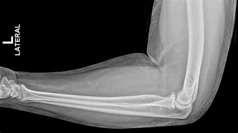 Coronoid Process Fracture Uni Clinic