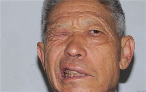 面瘫图片 面瘫症状表现图片大全 有来医生