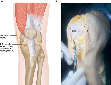 Saphenous Nerve Block
