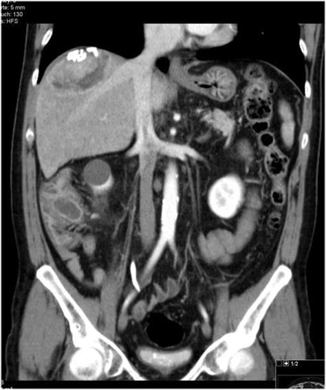 Neuroendokriner Tumor Der Appendix Pacs