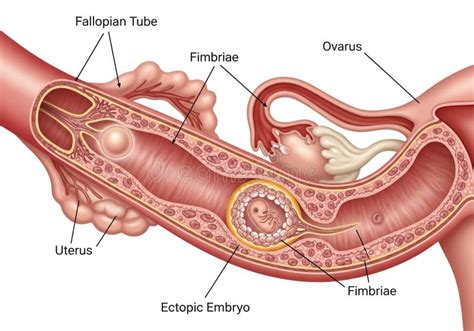 Medical Illustration Of An Ectopic Pregnancy Stock Illustration Illustration Of Scenario