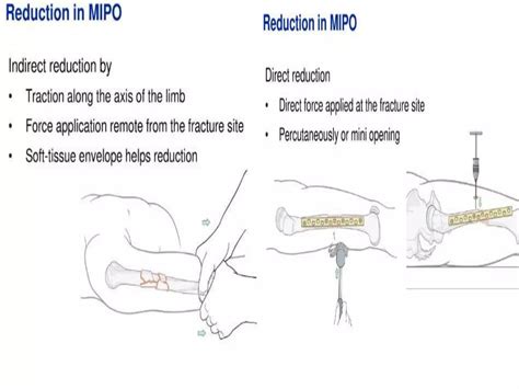 Treatment Of Segmental Femoral Fracture Pptx