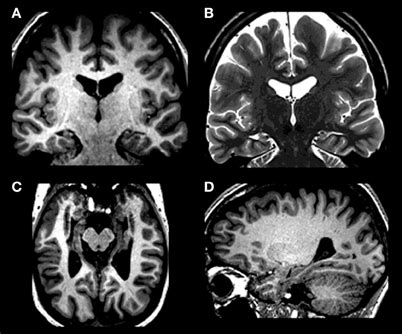 Bilateral Hippocampal Atrophy In Ml With T1 Weighted Images A