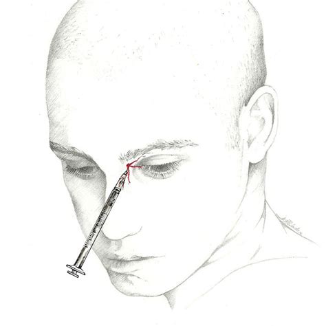 Approach To The Infratrochlear Nerve Download Scientific Diagram