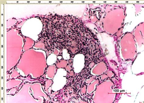 Focal Chronic Thyroiditis Patchy Lymphocytic Inflammation With Small Download Scientific