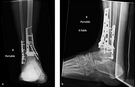 42 Pilon Fractures Musculoskeletal Key