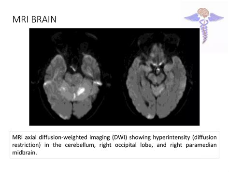 Ocular Tilt Reaction And Skew Deviation Pptx