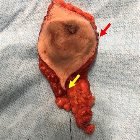 Surgical Specimen With Braided Silk Sutures Marking The Margins A