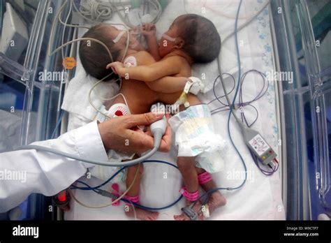 A Doctor Examines The Newborn Siamese Twin Sisters Kept In An Incubator