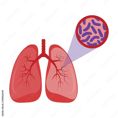 Lungs Of Infected Person Mycobacterium Tuberculosis Bacteria Danger