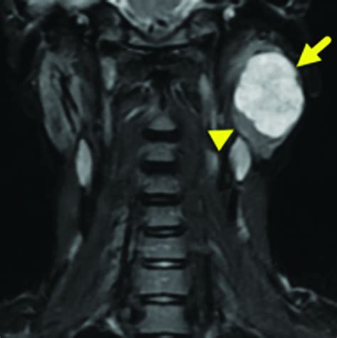 Pleomorphic Adenoma Of The Parotid Gland Applied Radiology