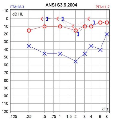 Audiology Class Question About Interpreting Audiogram For Test In Basic Bio R Audiology