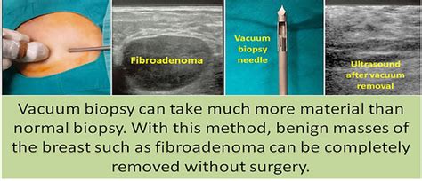 Interventional Radiology In Breast Cancer