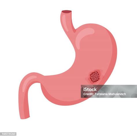 위암 악성 암 종양 해부학적 벡터 삽화 격리된 흰색 배경 만화 스타일 건강관리와 의술에 대한 스톡 벡터 아트 및 기타 이미지 건강관리와 의술 건강한 생활방식 과학
