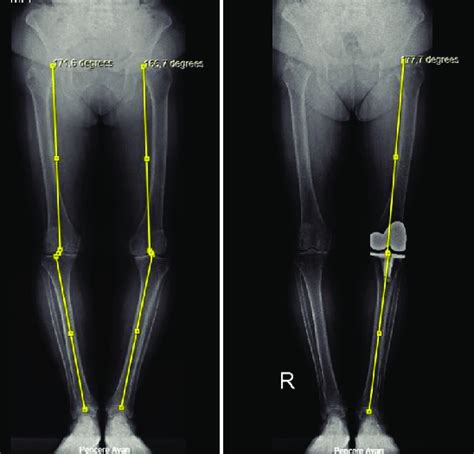 Picture Showing Improvement In Lower Extremity Alignment Before And Download Scientific Diagram