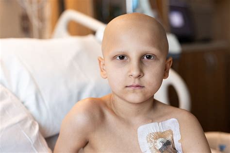 Non Ossifying Fibroma