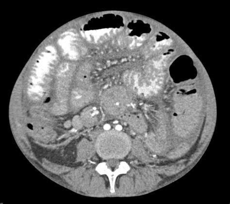 Thickened Small Bowel Secondary With Mycobacterium Aviumintracellulare