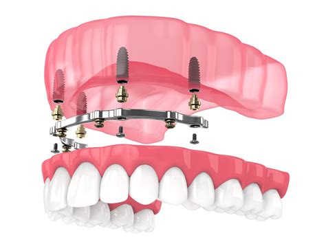 Implant Supported Dentures And Bridges Near Me In Strathcona